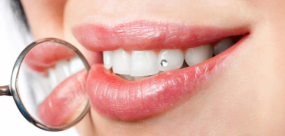 Zahnschmuck aufkleben & entfernen | Zahnarzt Rehberg